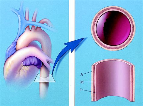 Pathogenesis In Acute Aortic Syndromes Aortic Dissection Intramural