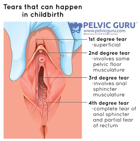 Rcog Guidelines Update Management Of Severe Perineal Tears 45 Off