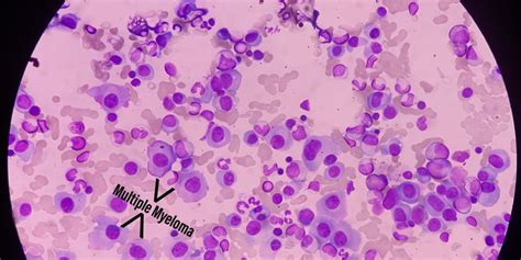 New Steps Toward Understanding The Evolution Of Multiple Myeloma