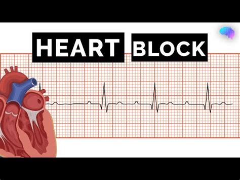 Heart Block AV Block ECG EKG OSCE Guide UKMLA CPSA