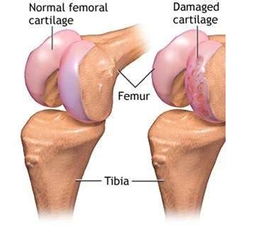Knee Replacement DOCJOINTS DR SUJIT JOS Joint Surgeon For Shoulder