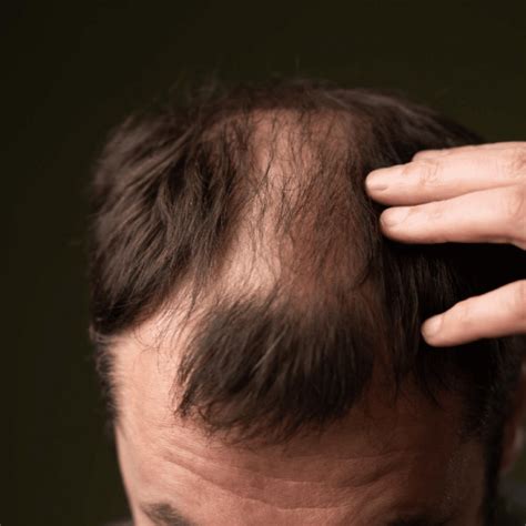 Haarausfall Behandlung Diagnose Direkt Vom Online Hautarzt Doctorderma