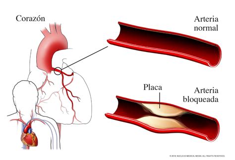 Cardiopatía coronaria Causas y factores de riesgo NHLBI NIH