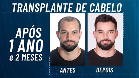 Transplante capilar antes e depois após 1 ano e dois meses YouTube