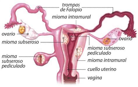 Miomas Uterinos Sociedad Espa Ola De Radiolog A Vascular E