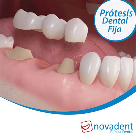 Qu Son Las Pr Tesis Dentales Fijas Novadent