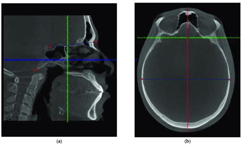 This Is A Figure Showing The Definitions And Measurements Of CBCT