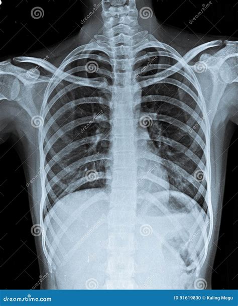 X Ray Chest Anatomy