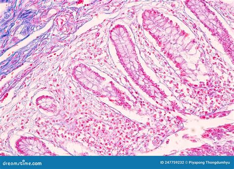 Small Intestine Duodenum And Vermiform Appendix Human Under The