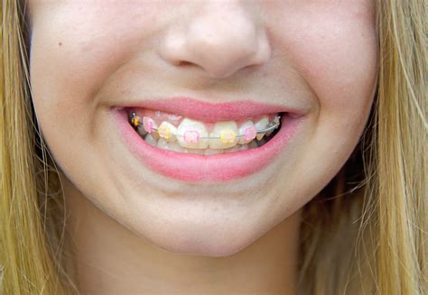 Ceramic Braces With Colored Bands