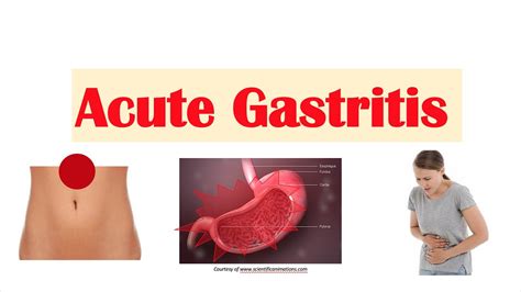 Acute Gastritis Stomach Inflammation Causes Signs Symptoms