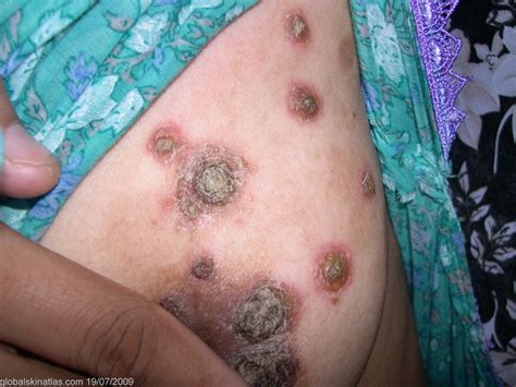 Global Skin Atlas Diagnosis Detail