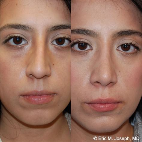 Eric M Joseph MD Rhinoplasty Before After Photos