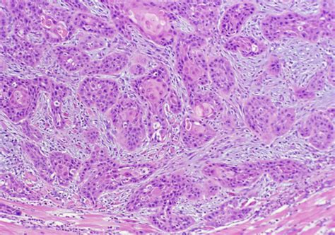 Pathology Neoplasia Flashcards Quizlet