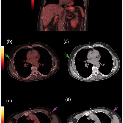 Preoperative Contrast Enhanced CT Transaxial A And Sagittal B