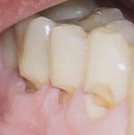 Abfraction Teeth