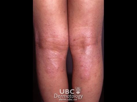 Interesting Facts About Atopic Dermatitis Eczema Infographic