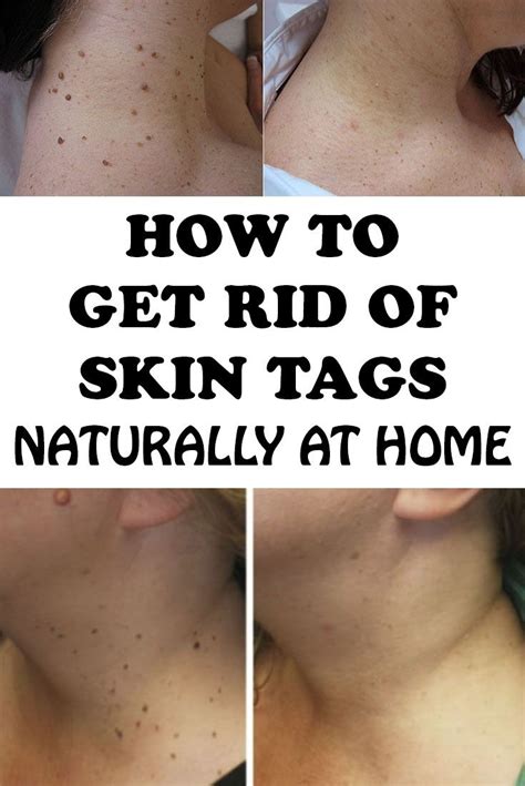 How To Remove Skin Tag On Neck Naturally Howtormeov