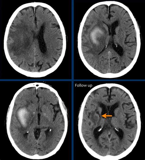 Intracerebral Hemorrhage Mri