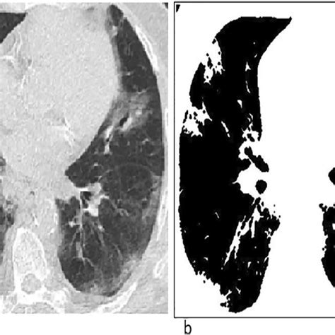 CT Scan Images After Morphological Operation A The Original Image B
