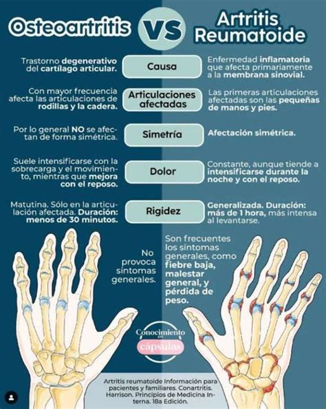 Diferencias Entre Artritis Y Osteoartritis Kulturaupice Hot Sex Picture