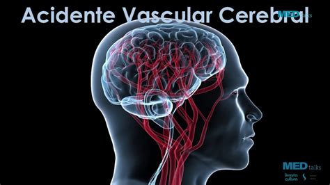 Acidente Vascular Cerebral Isquêmico Dr Rafael Waanabe YouTube