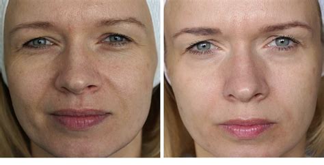 Laseroterapia frakcyjna 1550 nm 1927 nm usuwanie przebarwień