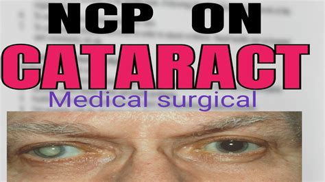 NURSING CARE PLAN ON CATARACT YouTube