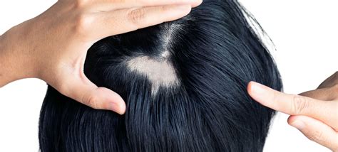 Queda De Cabelo Causas E Tratamentos Eficazes Blog Ada Tina