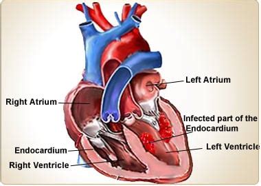 Infective Endocarditis Causes Symptoms Diagnosis Complications Treatment