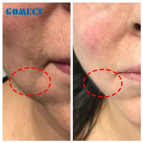 Minimal Invasive Laser Lipolysis 1470 980nm Medical Liposuction