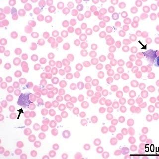 Heme Wbc Abnormalities Flashcards Quizlet