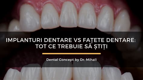 Implanturi VS Fațete Dentare tot ce trebuie să știți Dental Concept