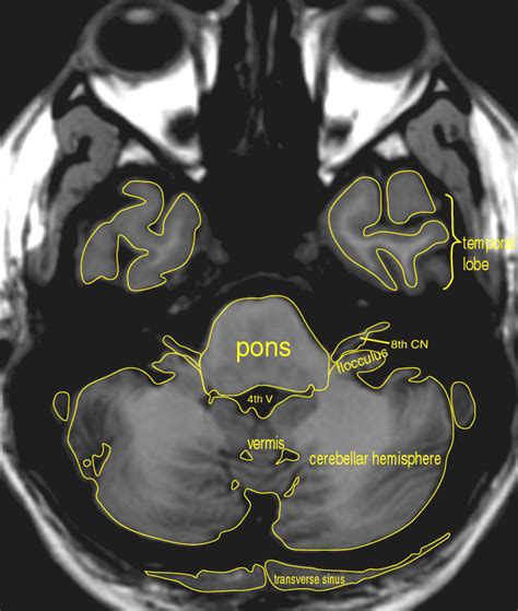 Cerebellum Anatomy Mri