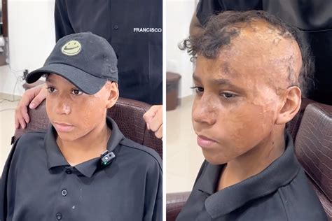 12 Year Old Burn Victim Gets His Hair Back After A DecadeWatch His