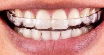 Bruxismo O Que E Como Tratar Dentista Em Santo Andr