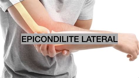 Epicondilite Lateral Youtube