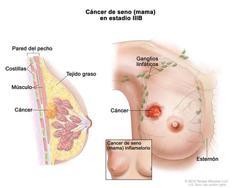 Cache Anuncio Sofisticado Cuales Son Las Consecuencias Del Cancer De
