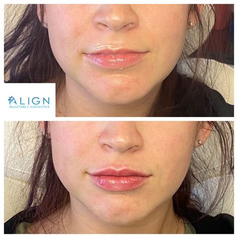 Pin By Align Injectable Aesthetics On Before And After Lip Fillers