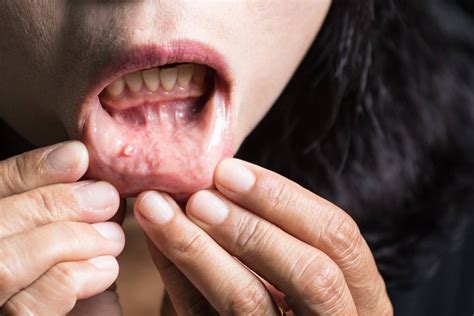 Oral Cancer Cases Are Being Found In People Below The Age Of Its