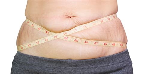 How To Get Rid Of Stretch Marks NaturallyHow To Get Rid Of Stretch