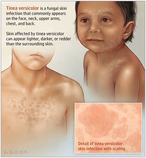 Ketoconazole For Pityriasis Aka Tinea Versicolor And