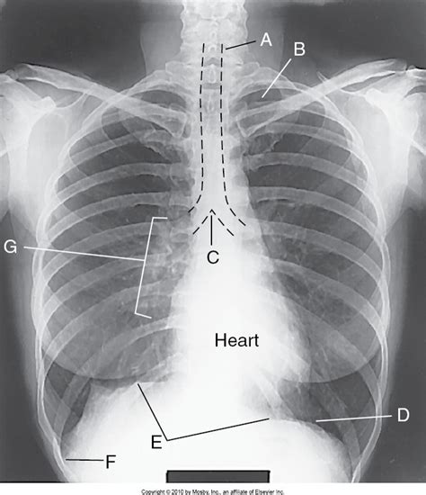 Radiological Anatomy X Ray Ct Mri Kenhub Off