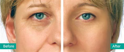 Ultherapy A Non Surgical Facelift Dr T Aesthetics
