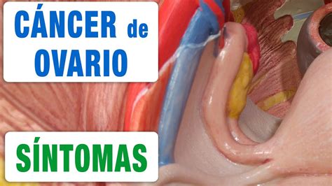 Todos los Síntomas del Cáncer de Ovario YouTube
