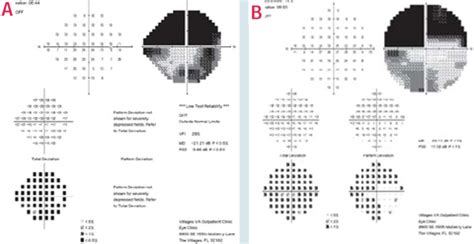 10 2 Visual Field Testing A Tool For All Glaucoma Stages