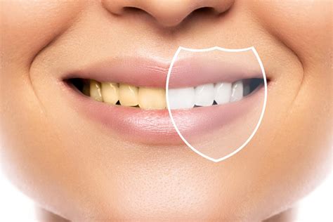 Mitos E Verdades Sobre O Clareamento Dental
