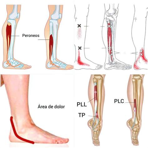 Tendinitis De Los Peroneos Ejercicios Y Tratamiento En Fisioterapia