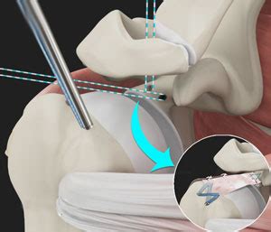 Arthroscopic Superior Capsular Reconstruction Virginia Rotator Cuff