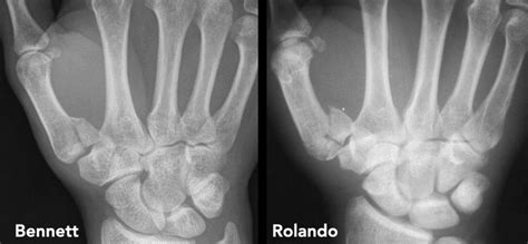 Silvio Rolando Litfl Medical Eponym Library